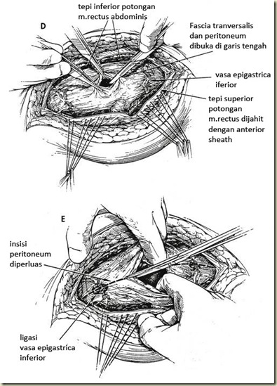 INFORMASI REPRODUKSI: TEHNIK LAPAROTOMI